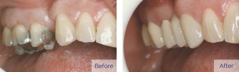 Mercury-Free Fillings Rochester, NY | Holistic Dental Solutions