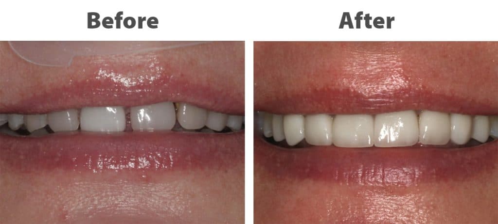 Smile Correction Approach