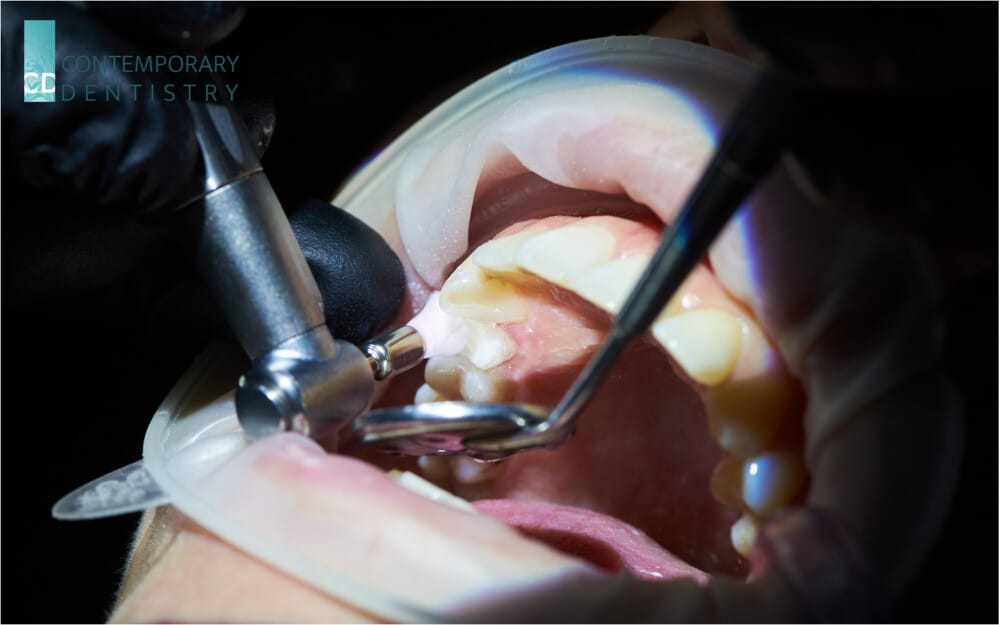 Alternatives to Root Canal Therapy: Your Complete Guide