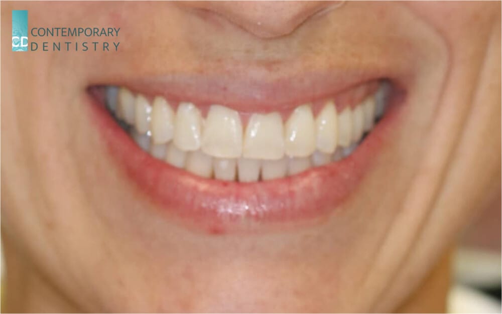 Alternatives to Root Canal Therapy: Your Complete Guide