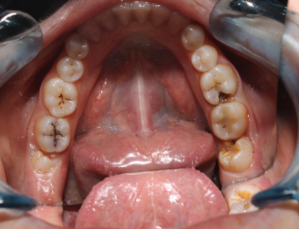 11 Reasons Your Teeth Keep Breaking | Rochester, NY Dentists