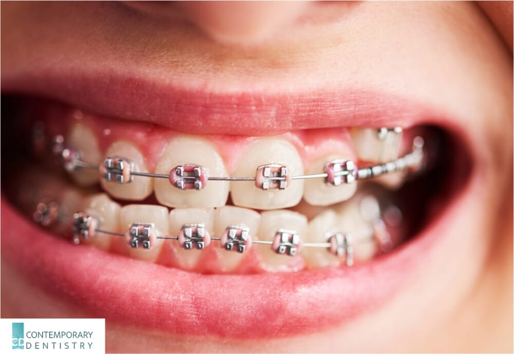 Is Invisalign Cheaper Than Braces? | Cost in Rochester
