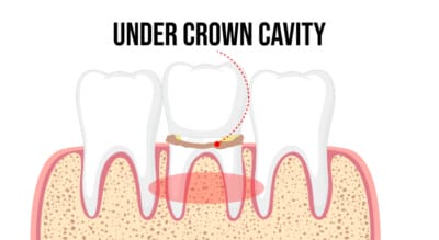 Can You Get a Cavity Under a Crown? What You Need to Know